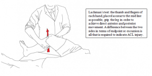 Diagnosing the Torn ACL in the Acute Knee – Tim Spalding